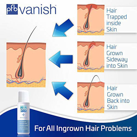 GetUSCart- PFB Vanish Razor Bump Stopper Skin Care Treatment with ...
