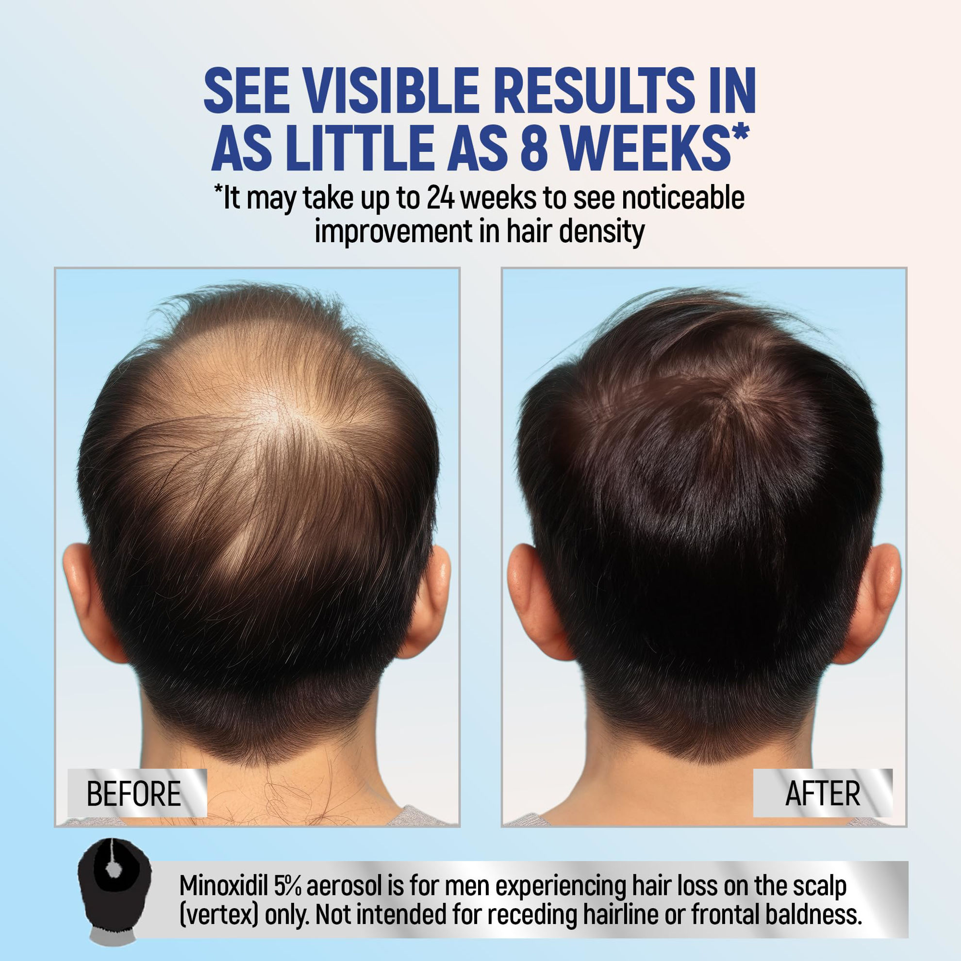 GetUSCart- Taro Minoxidil Topical Aerosol Foam, 5%, Hair Regrowth 2 ...