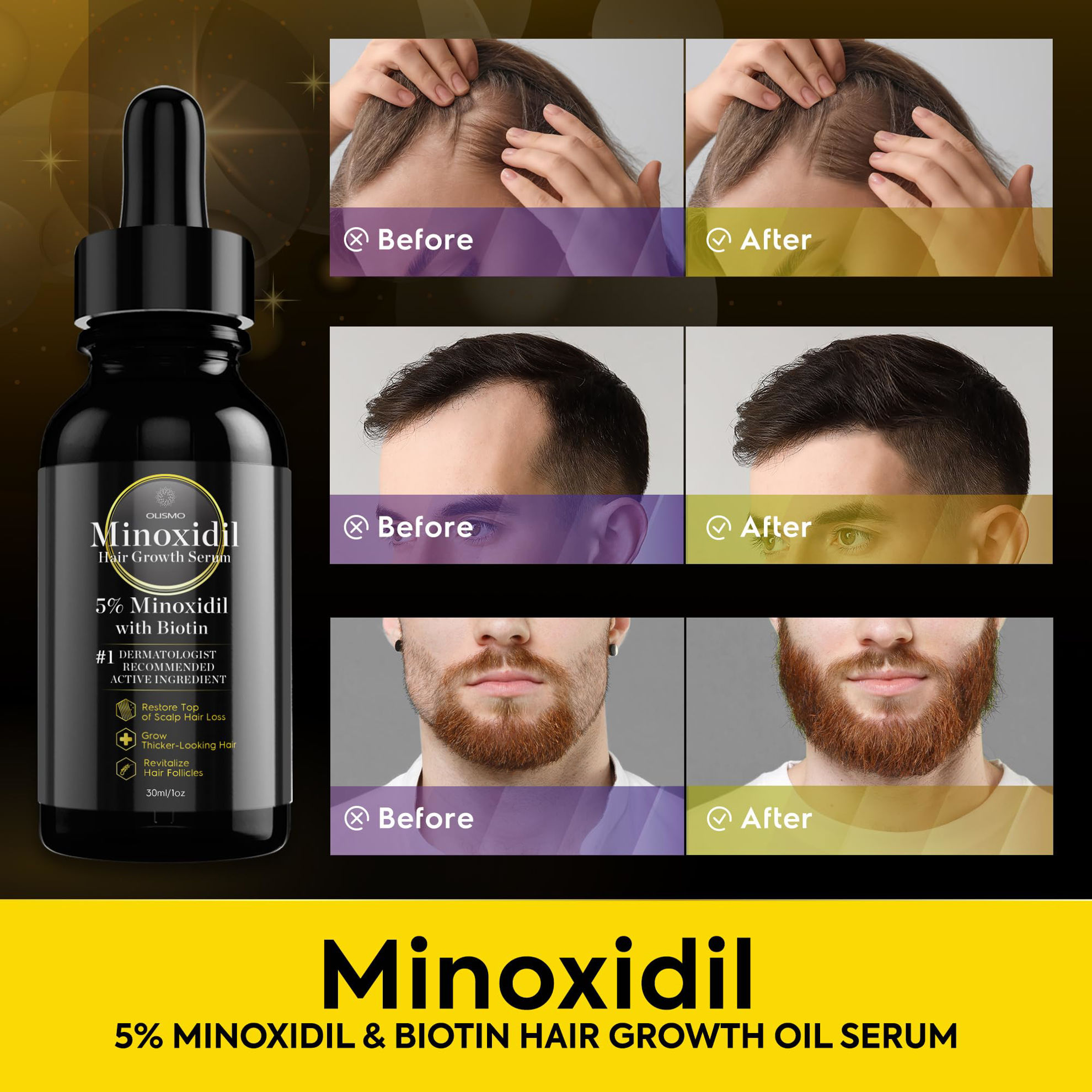 GetUSCart- 5% Minoxidil Hair Growth Serum, Minoxidil Hair Growth ...
