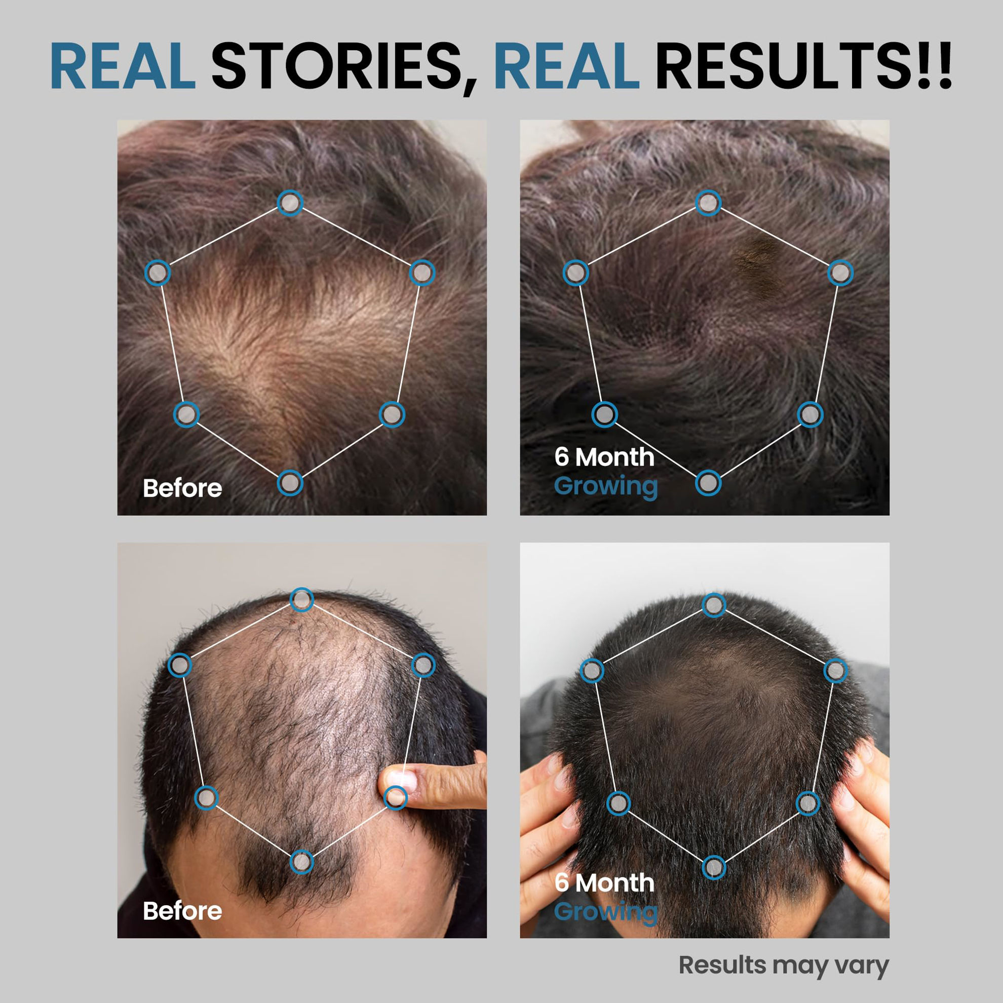 GetUSCart- Minoxidil for Men Hair Growth, 5% Minoxidil Hair Growth ...