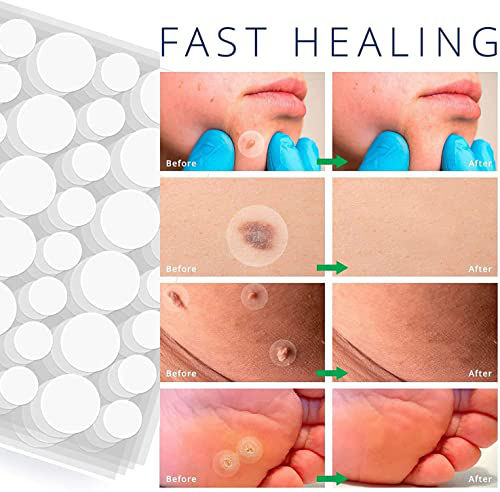 GetUSCart- Upgraded Skin Tag Remover Patches (144 Pcs), Skin Tag Device ...