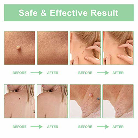 GetUSCart- DINHAND Skin Tag Remover, Micro Skin Tag Removal Kit for ...