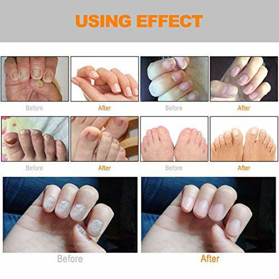 GetUSCart- Fungus Stop, Fungus Treatment, Anti-Fungal Nail Solution for ...